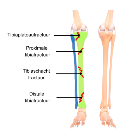 Herstel van een gebroken scheenbeen - Revalidatiegids.nl