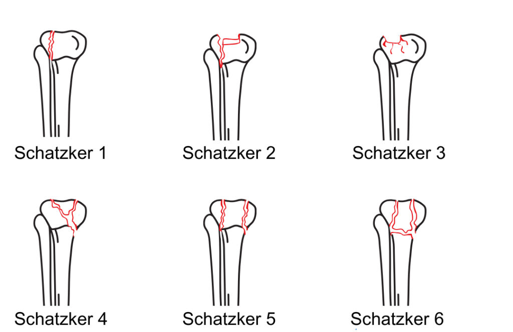 Herstel van een gebroken scheenbeen - Revalidatiegids.nl
