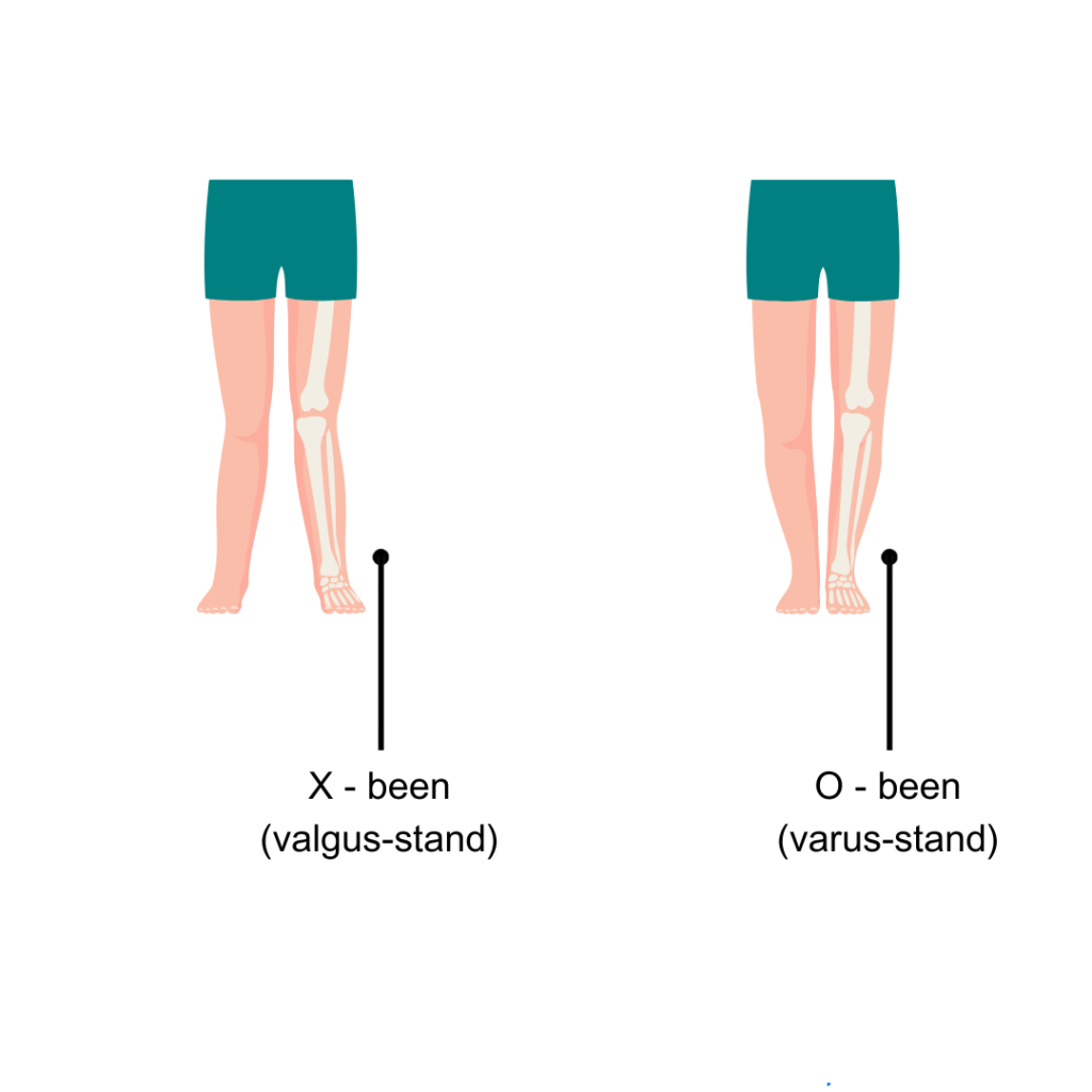 Herstel van een gebroken scheenbeen - Revalidatiegids.nl