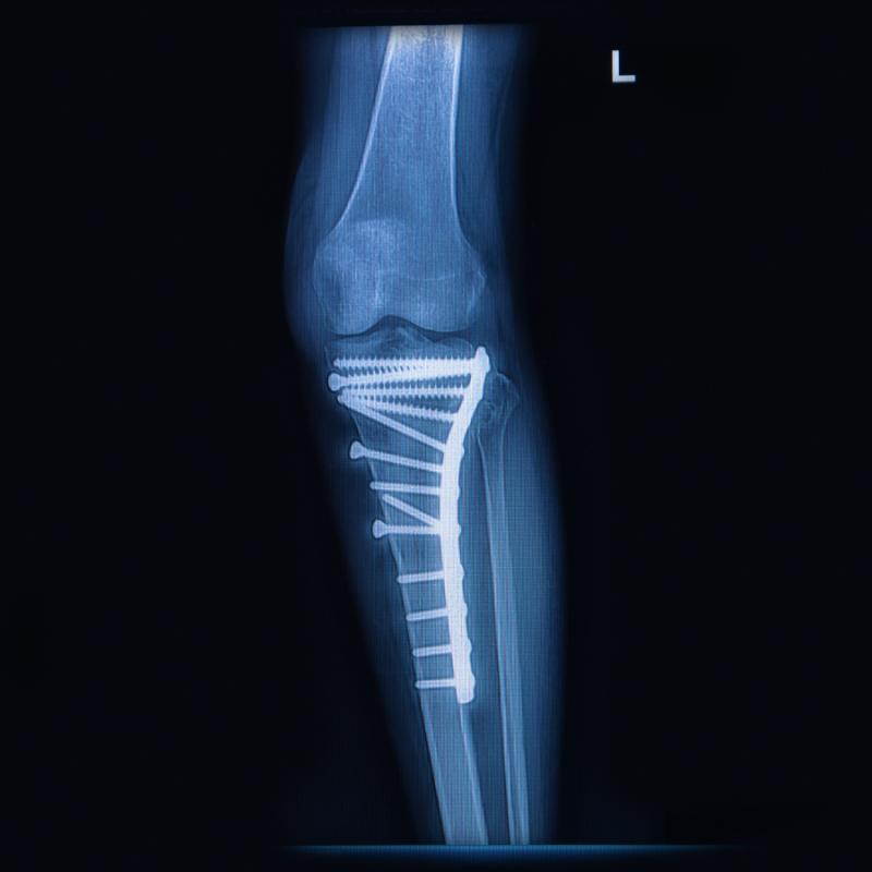 Voorkomen van complicaties na tibia(plateau)fractuur - Revalidatiegids.nl